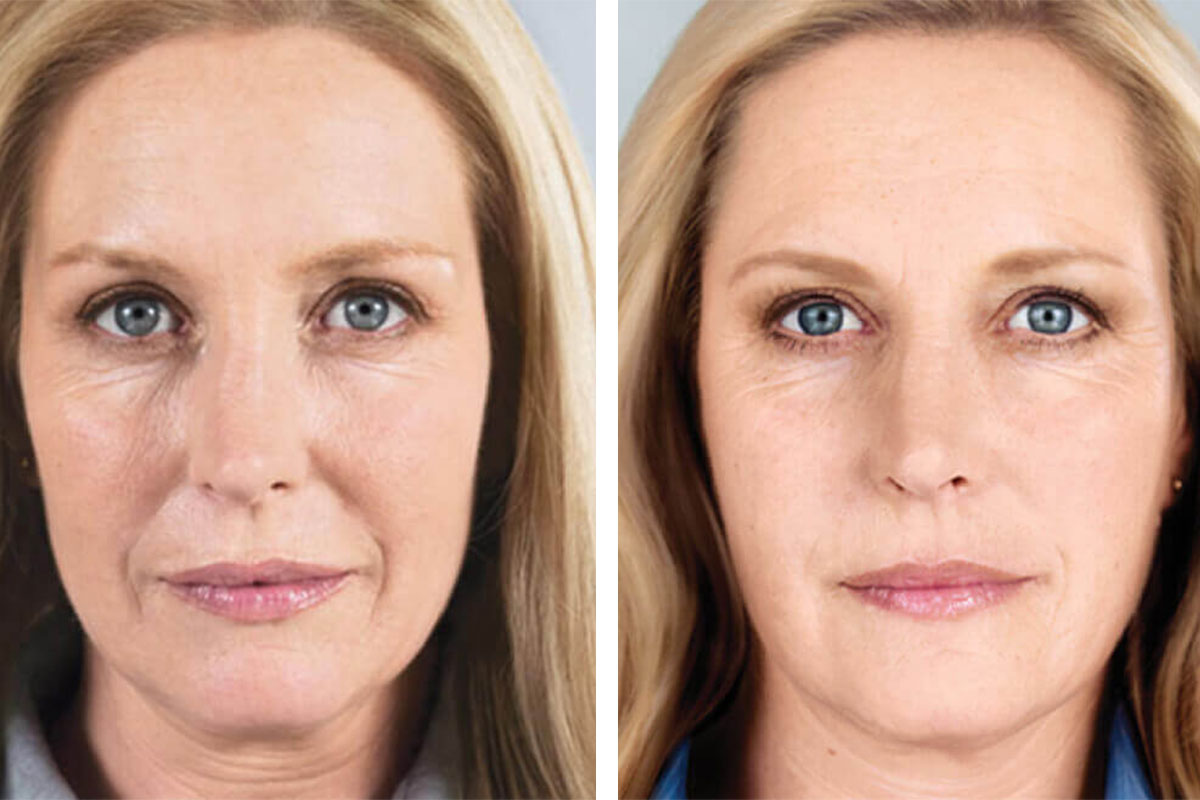 Sculptra Filler in Austin, TX | Renu Well Aesthetics and Wellness