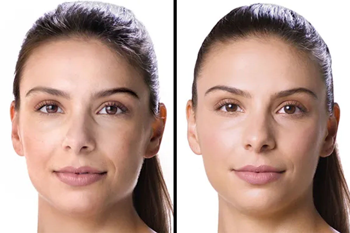 Juvéderm in Austin, TX | Renu Well Aesthetics and Wellness