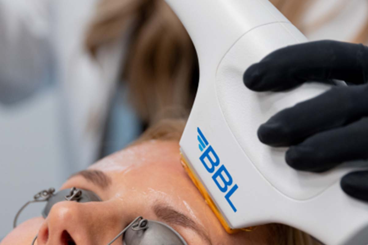 BBL Hero in Austin, TX | BBL Photofacial in Austin, TX